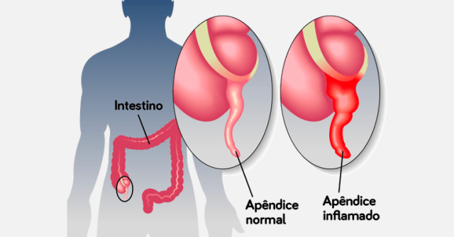 Inchaco De Apendicite Apendicite é A Inflamação Do Apêndice, A